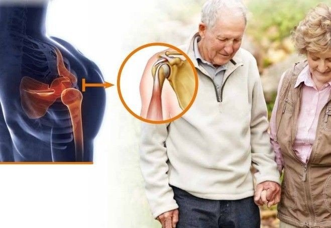 Shoulder brace with forearm strap Orliman Neuro-Conex 94303 | e ...